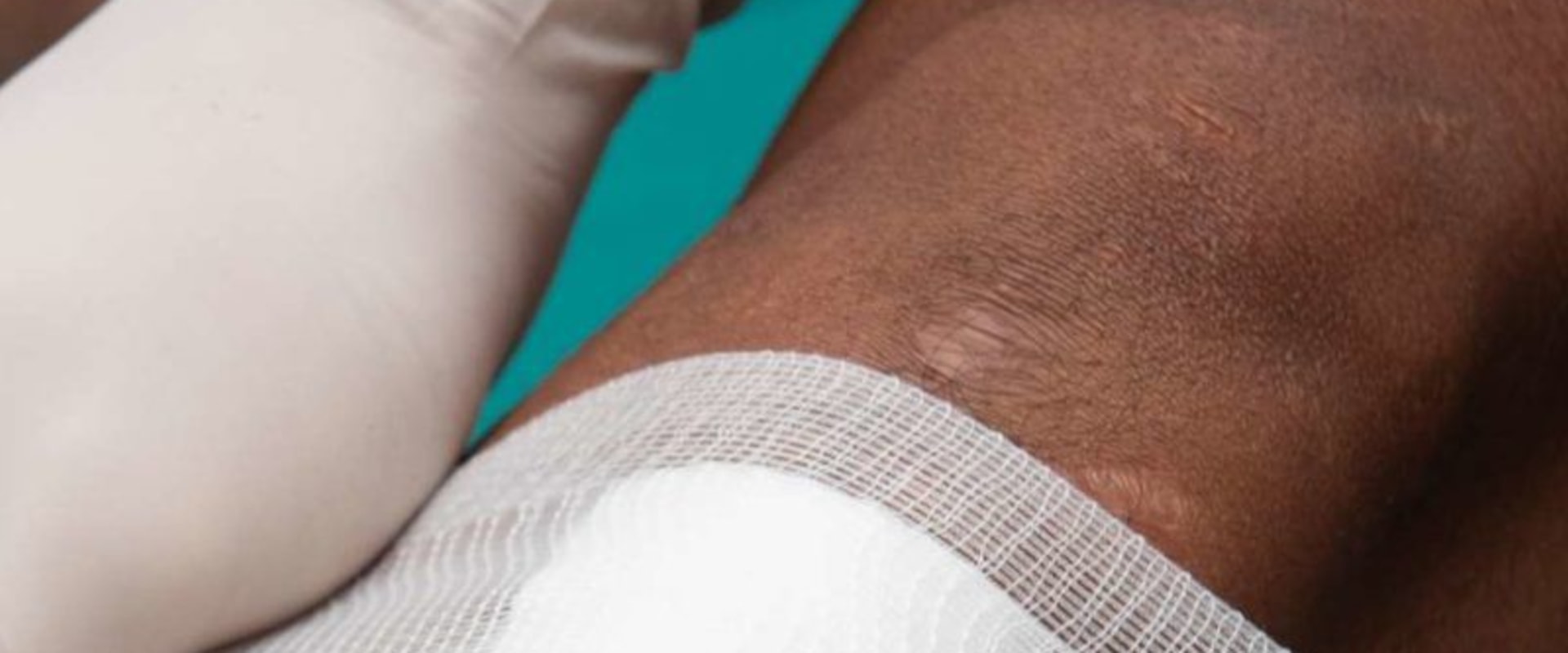 The Best Dressings for Open Wounds: An Expert's Perspective