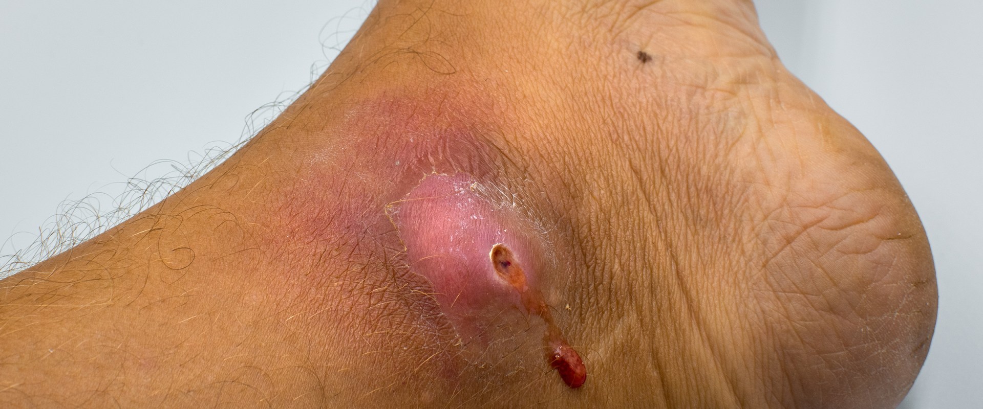 The Truth About Wound Healing: Covered or Uncovered?