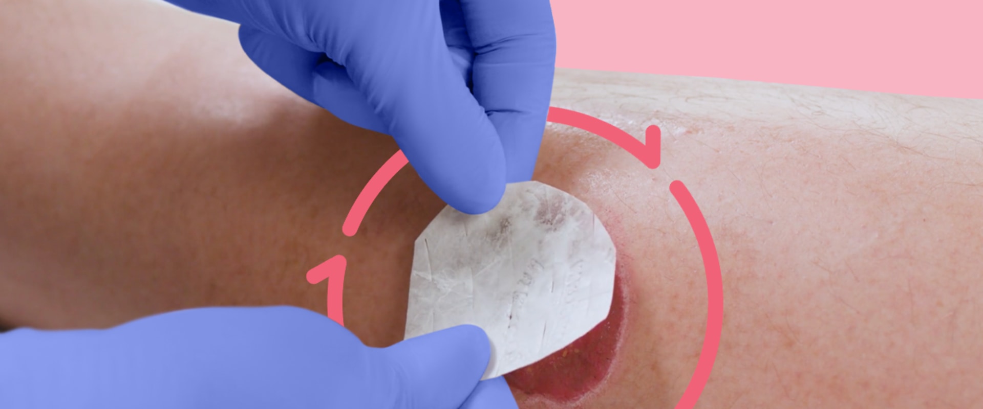 How To Manage Collagen Wound Dressing Side Effects With Gauze Dressings
